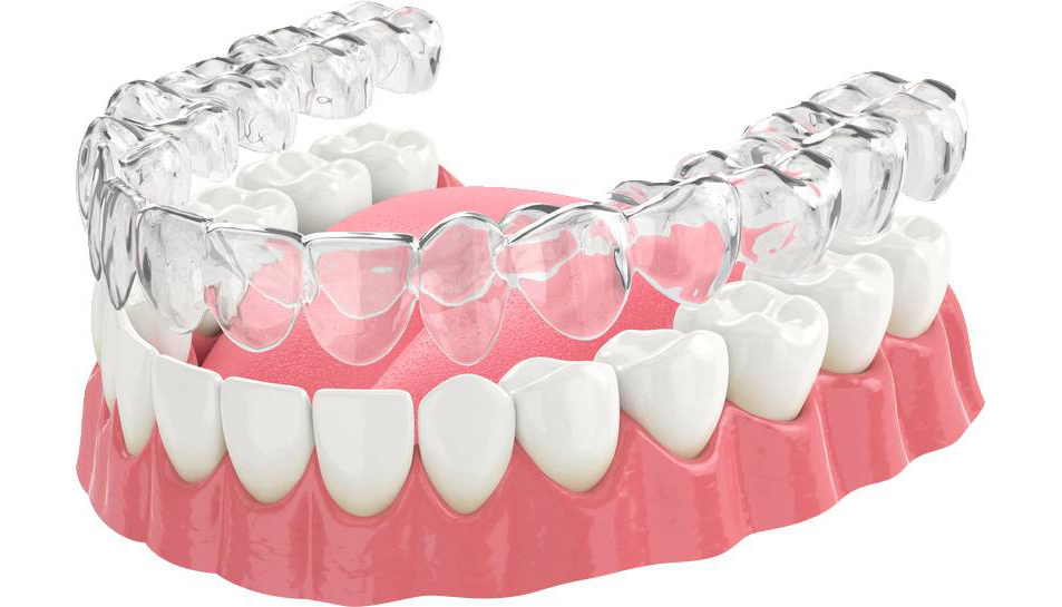 Teeth Retainers | German Dental Clinic Dubai JLT